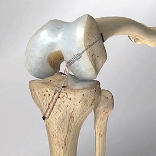 Reparación Del Ligamento Cruzado Anterior Sin Cirugía – APAYEF
